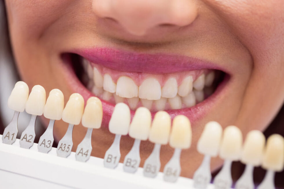 Composito dentale: vantaggi, durata e applicazioni